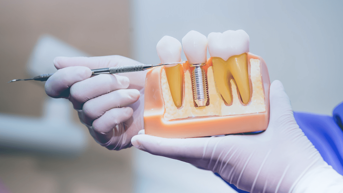 How Dental Implants Preserve Jawbone Health | White Bear Lake MN