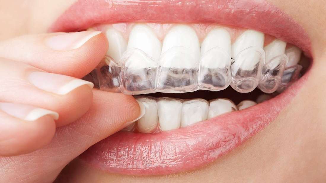 What Is SureSmile®? | SureSmile® Clear Aligners White Bear Lake MN